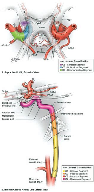 Ophthalmic Artery Aneurysms Neupsy Key