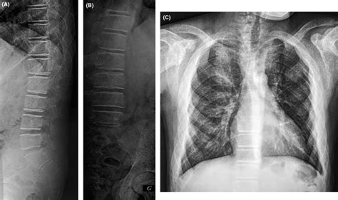 Spinal A And B And Chest © X‐ray Diffusely Osteopenic Skeletal
