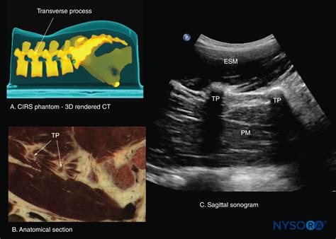 Spinal Sonography And Applications Of Ultrasound For Central Neuraxial