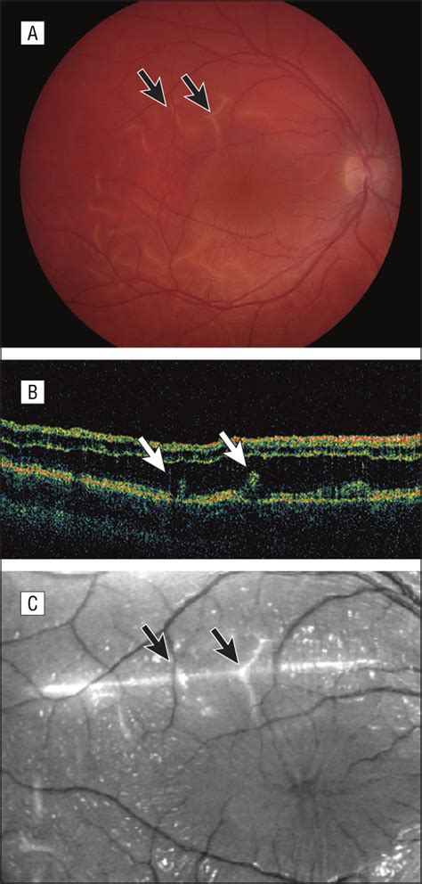 Outer Retinal Corrugations In X Linked Juvenile Retinoschisis
