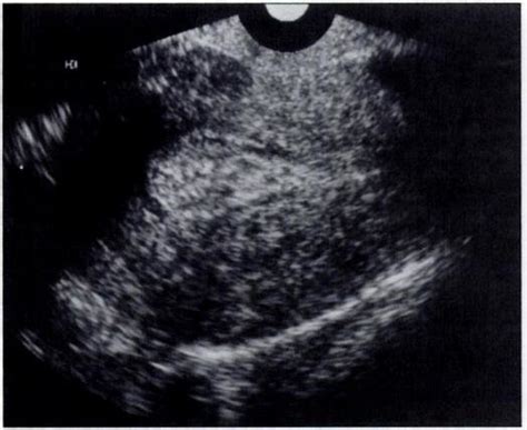 Endometrial Polyp In 42 Year Old Woman A Sagittal Transvaginal