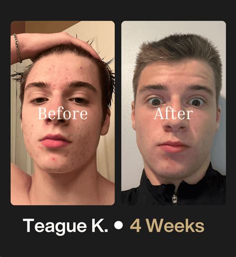 Shield System 10 Reasons I Trust Shield For Clear Skin