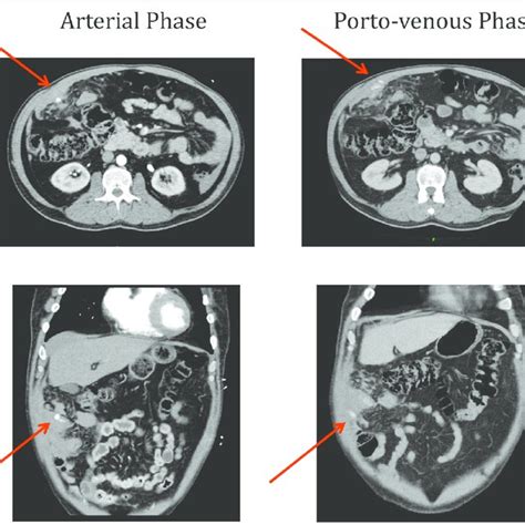 Ct Abdomenpelvis With Iv Contrast With Arterial And Porto Venous