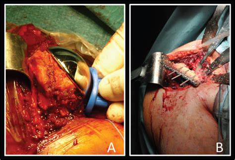43 Stemless Anatomic Shoulder Replacement Musculoskeletal Key