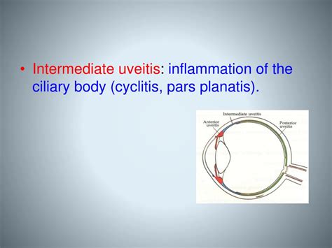 Ppt Uveitis Causes Types Diagnosis Powerpoint Presentation Free