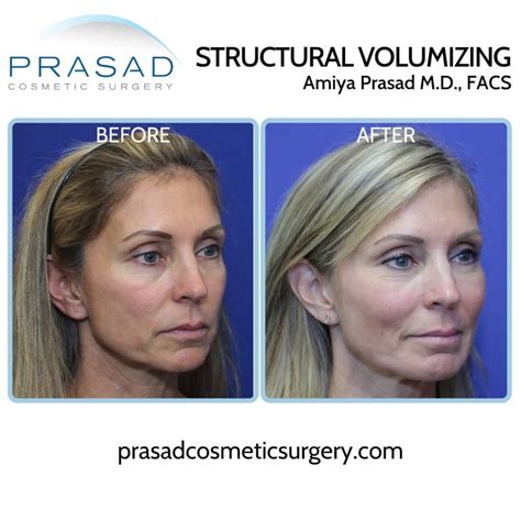 Cheek Fillers Vs Implants Benefits Risks And Results
