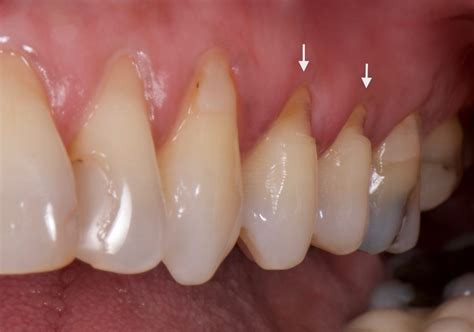 Abfraction Teeth