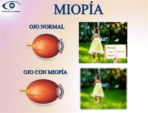 Miopia Oftalmologia Obispado Monterrey