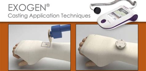 Exogen Casting Application Techniques Exogen Ultrasound Bone Healing System