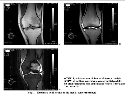 Bone Bruise Knee Mri