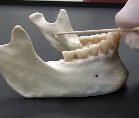 Dental Anesthesia Nerve Block At Terry Haskell Blog