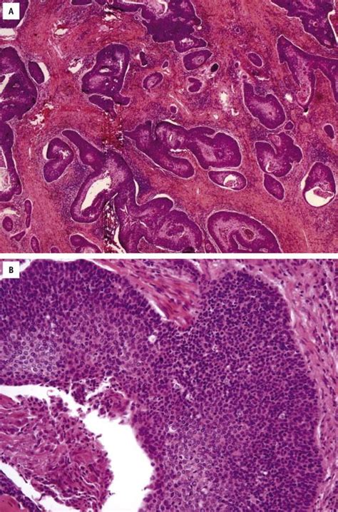 Diseases Of The Penis Urethra And Scrotum Clinical Tree