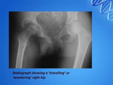Tuberculosis Of Hip Pptx