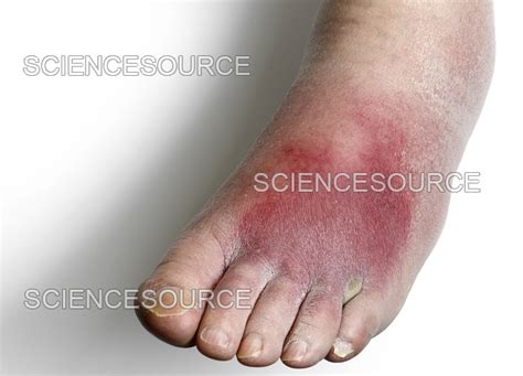 Cellulitis Foot