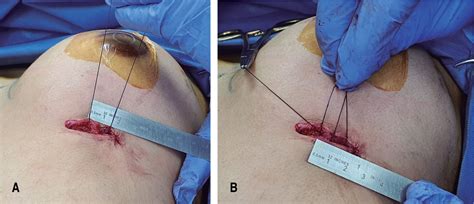 Triangular Triple Suture For Scar Reduction In Breast Augmentation With