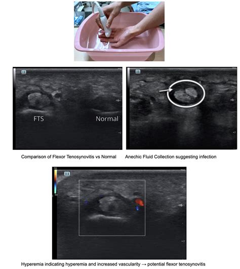 Flexor Tenosynovitis — Kwak Talk
