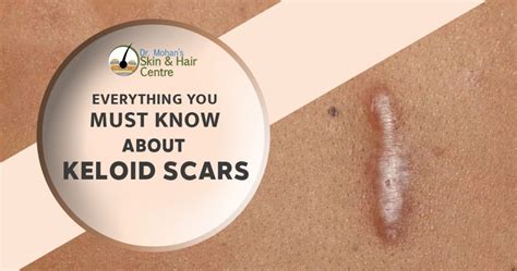 Everything About Keloid Scars