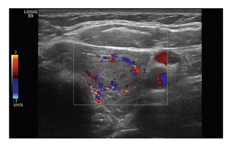Hashimoto Thyroiditis Beyond Cytology A Correlation Between