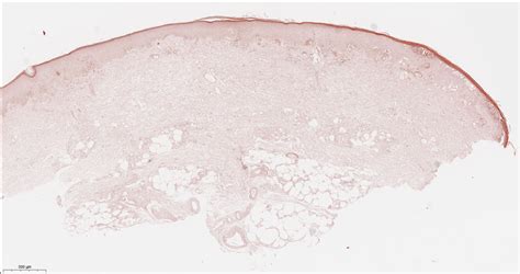Calciphylaxis Causing Skin Gangrene In An Old Woman With End Stage