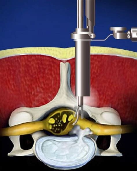 Endoscopic Discectomy — Epic Pain Mgmt 973866 0336