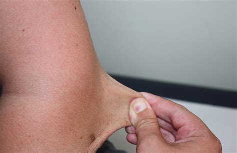 Ehlers Danlos Syndromes The Bmj