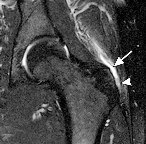 Sports Injuries About The Hip What The Radiologist Should