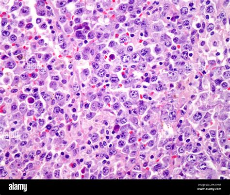 Diffuse Large B Cell Lymphoma Light Micrograph Stock Photo Alamy