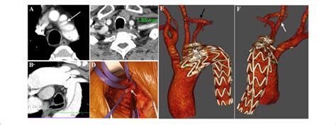 Zone 2 Tevar Preoperative Cta Showed The Presence Of A Complex