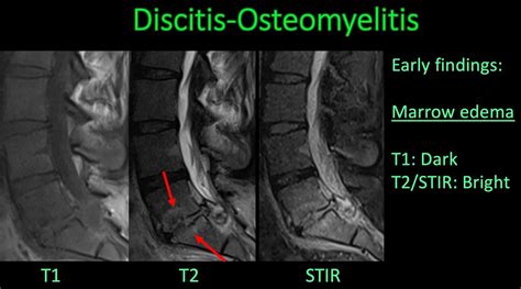 Osteomyelitis Mri Spine