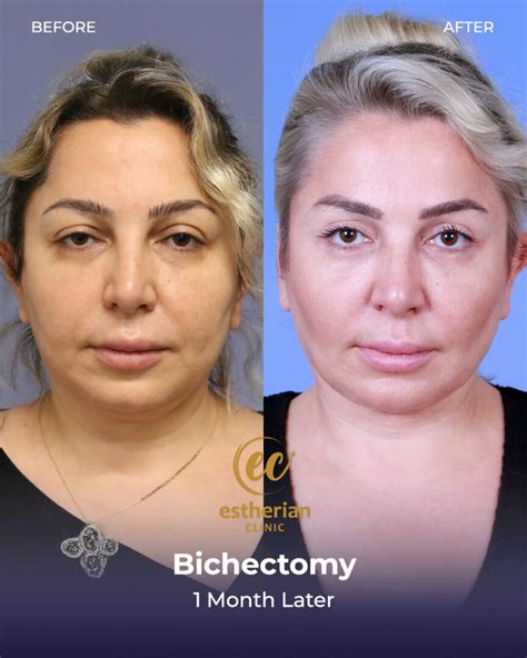 Bichectomy Buccal Fat Removal Surgery In Turkey Estherian Clinic