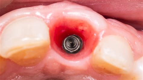 Dental News Experts Agree On Standards For Clinical Treatment Of Peri Implant Soft Tissue