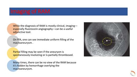 Retinal Artery Macroaneurysm Pptx