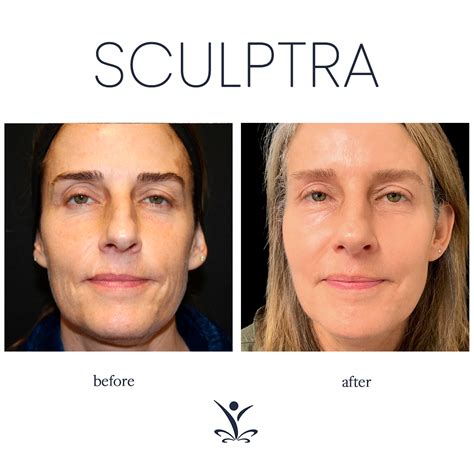 Before And After Sculptra Sculptra Medical Aesthetic Face Fillers