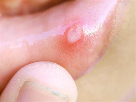 Canker Sore Stages Stages Of Cold Sores And How To Treat Fever Blisters