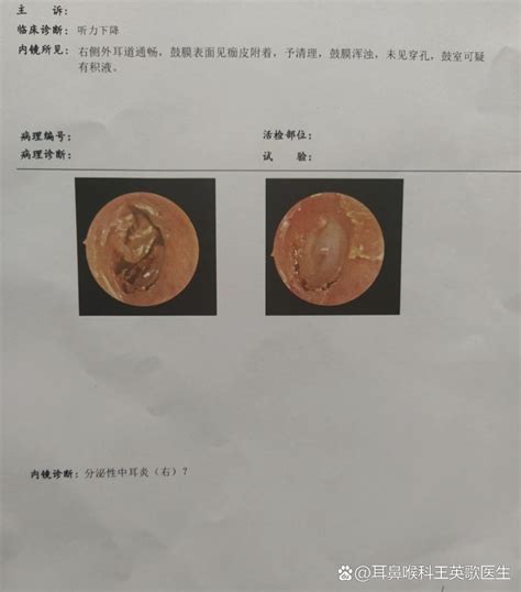 耳朵掏出白色软软一小坨是什么？