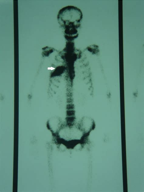 Emission Computed Tomography Showed Radionuclide Uptake On The Right