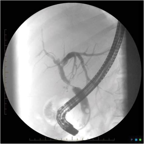 Orthotropic Transplant