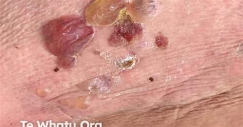 Bullous Pemphigoid Blisters Image