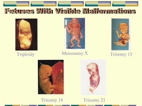 Complete Triploidy Syndrome At Carolyn Ring Blog