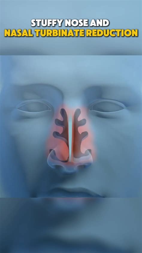 Stuffy Nose And Nasal Turbinate Reduction 3d Animation Stuffynose S