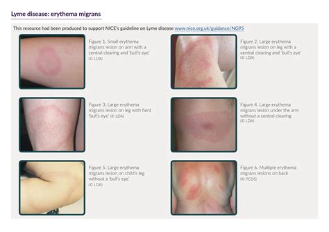 Erythema Migrans