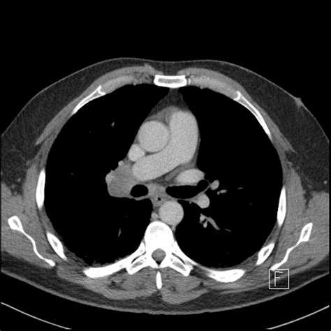 Radiopaedia Case Azygos Arch Thrombosis Id 79907 Study 93167 Nc Commons