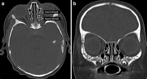 Ethmoid Sinus Stage 1 Development In An 11 Day Old Boy A B Axial A