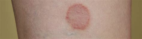 Buni Ringworm Sintomas Sanhi Mediko Ph