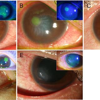 Tear Break Up Time In Recurrent Corneal Erosion Syndrome Eyes And