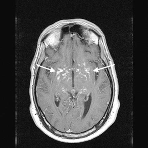 Clinical Images A Rare Case Of Cryptococcal Meningoencephalitis In An