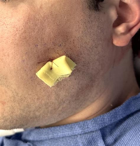 Cheek Bolsters For Buccal Lipectomy Reversal Dr Barry Eppley Explore Plastic Surgery