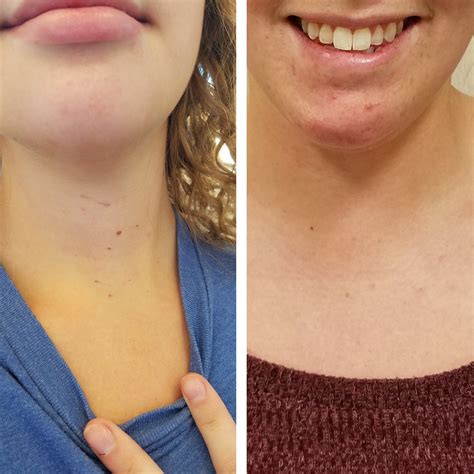 Thyroid Removal Surgery Scar At Nancy Colon Blog