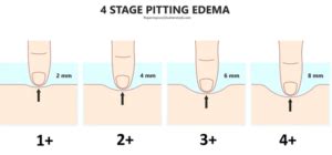 Fluid Volume Excess Or Overload Hypervolemia And Water Intoxication