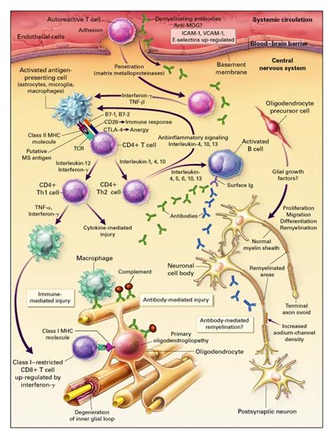 Disseminated Sclerosis